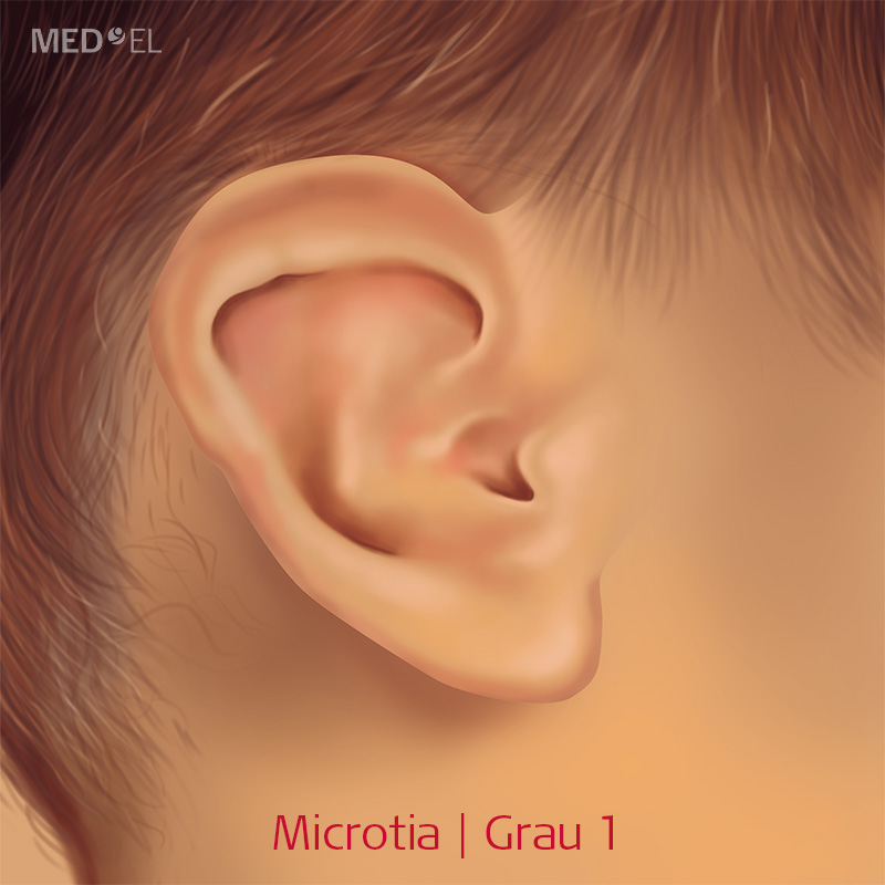 Soluções para Surdez causada por Microtia e Atresia - Ouvir Melhor
