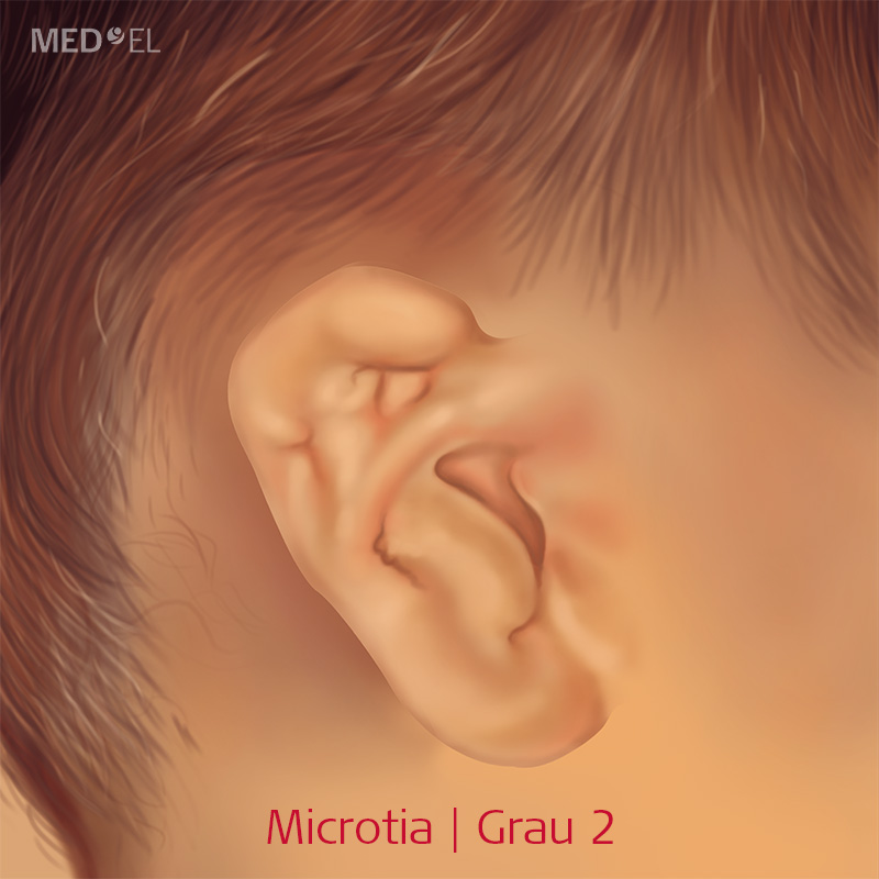 Soluções para Surdez causada por Microtia e Atresia - Ouvir Melhor