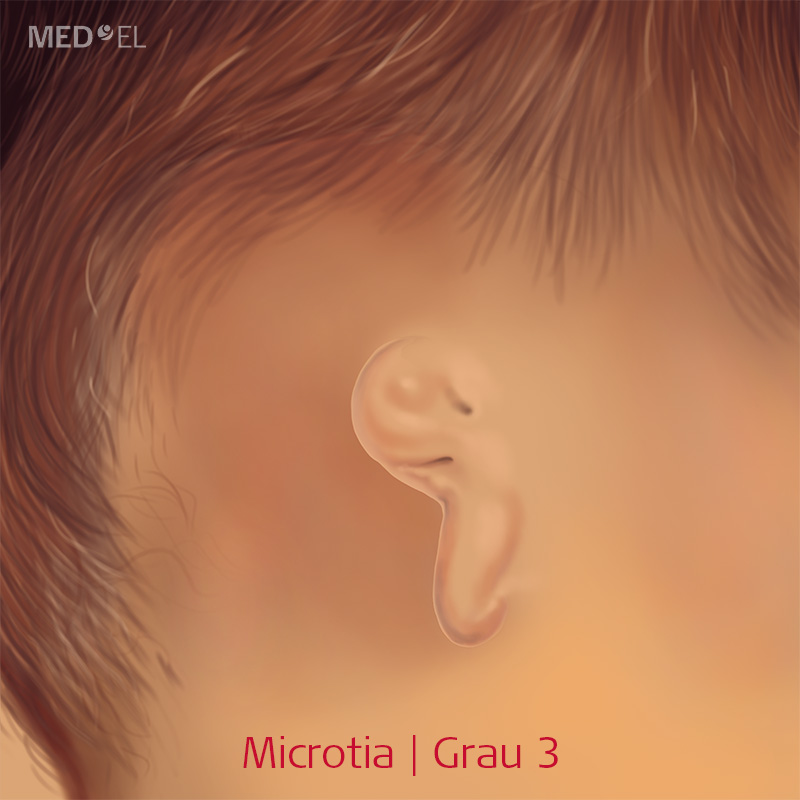 Soluções para Surdez causada por Microtia e Atresia - Ouvir Melhor