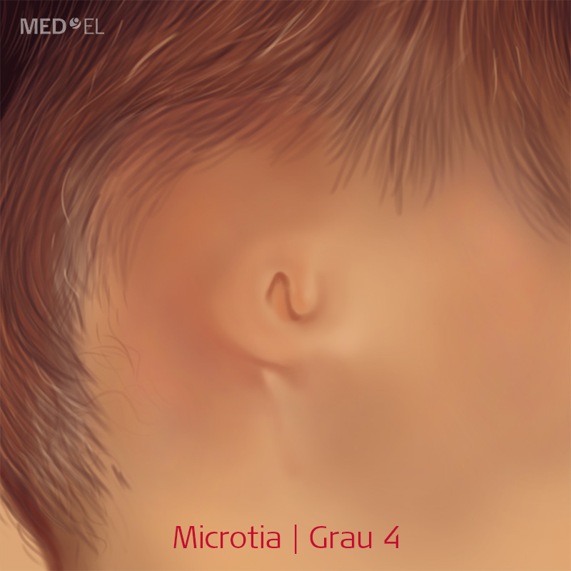 Soluções para Surdez causada por Microtia e Atresia - Ouvir Melhor